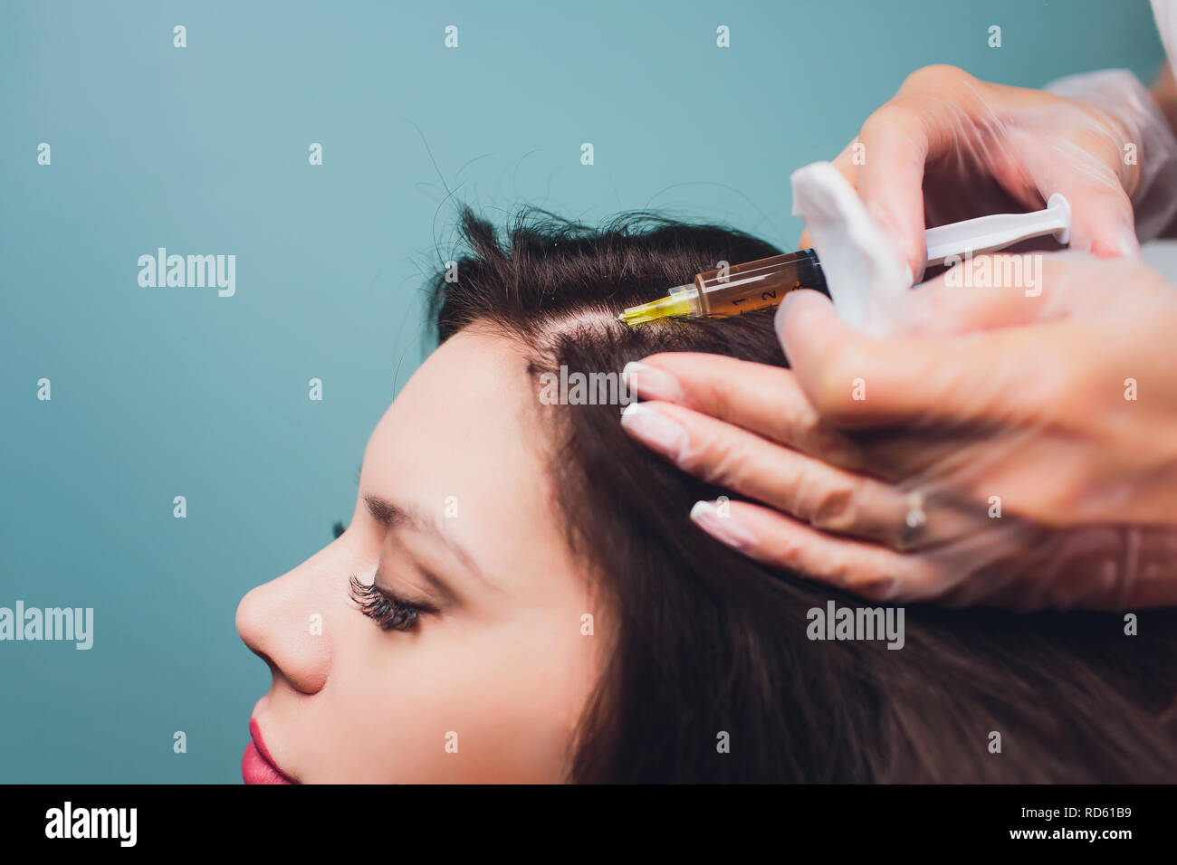 Platelet rich plasma injection procedure. Hair growth stimulation. PRP ...