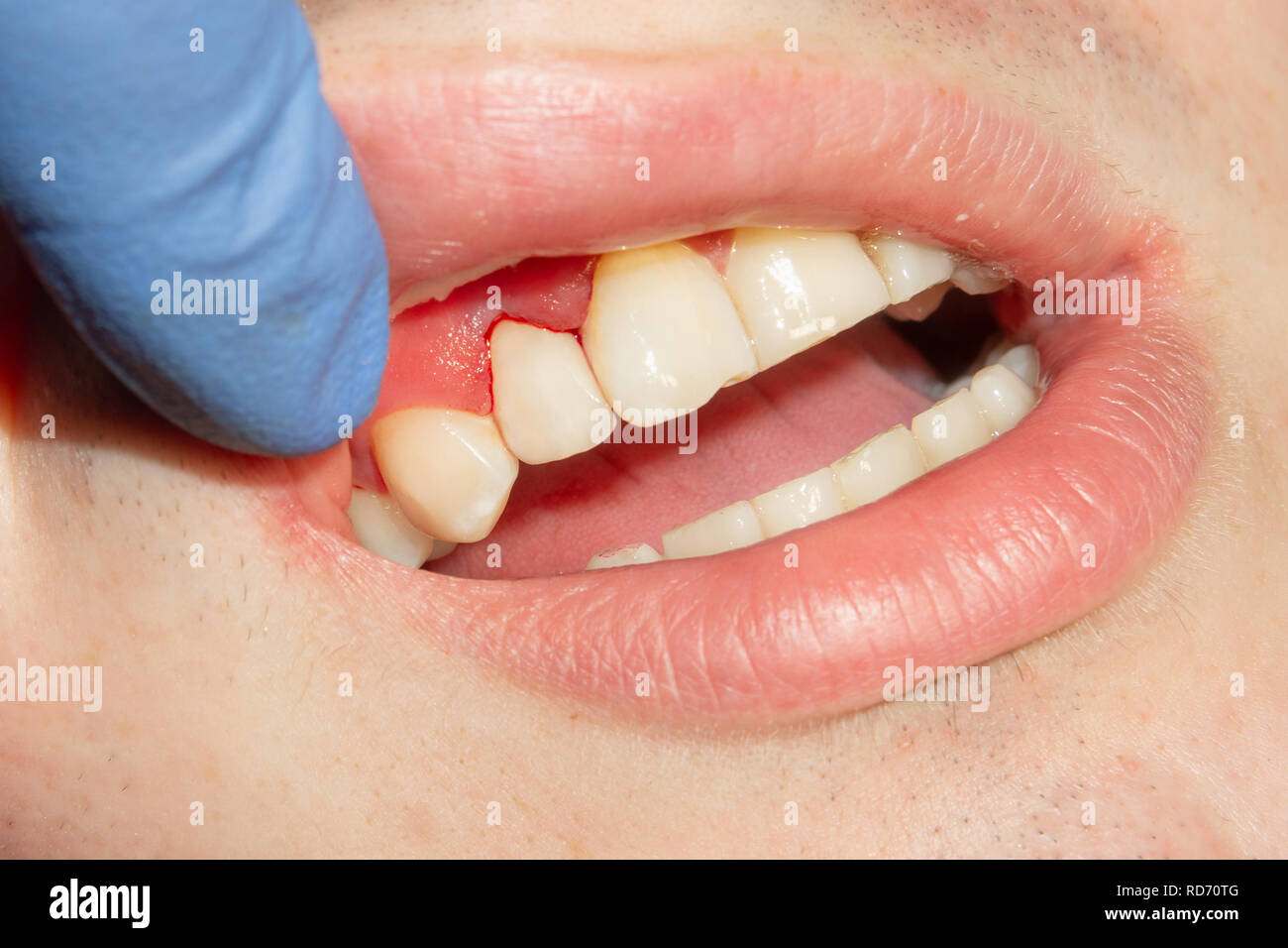 two chewing side teeth of the upper jaw after treatment of caries ...