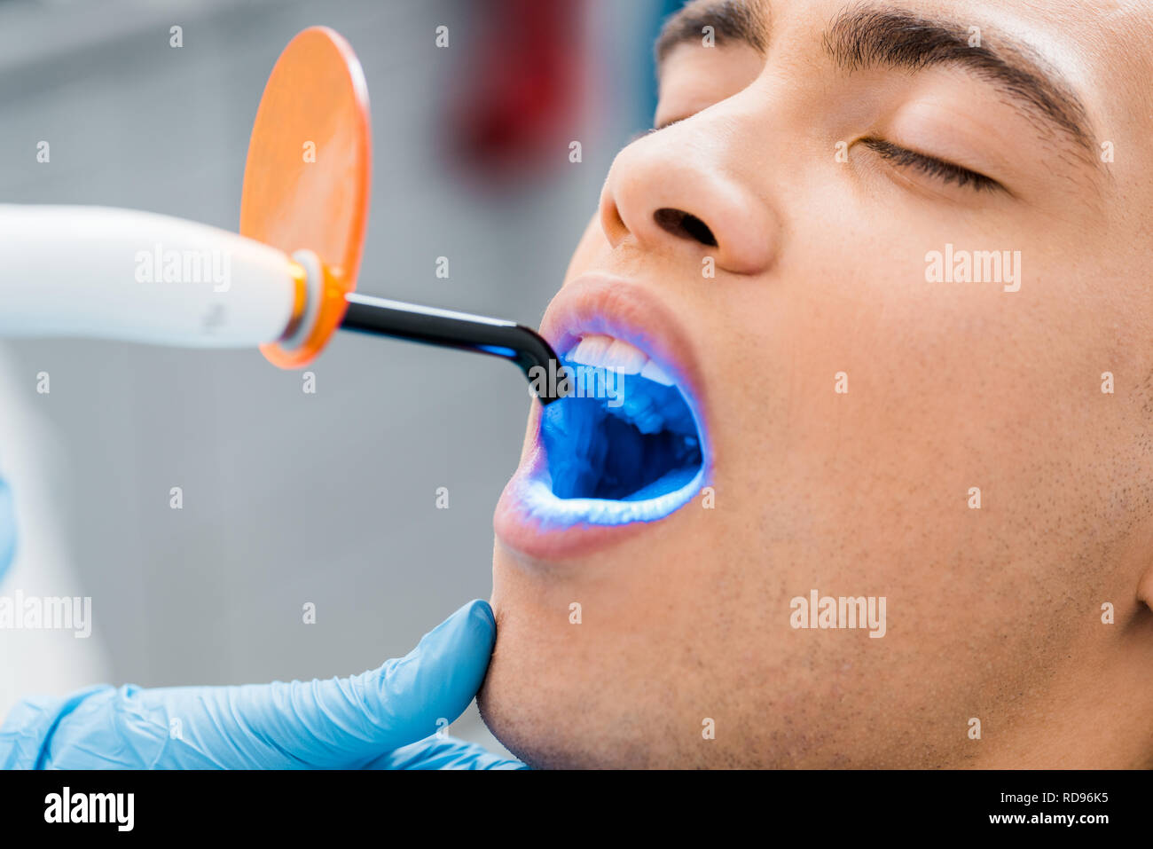 Bleaching procedure hi-res stock photography and images - Alamy