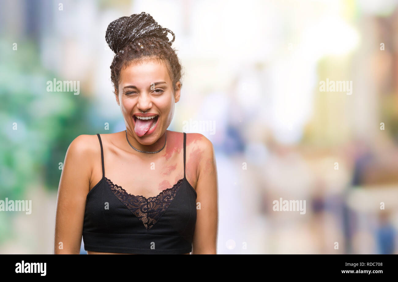 Young braided hair african american with pigmentation blemish birth ...