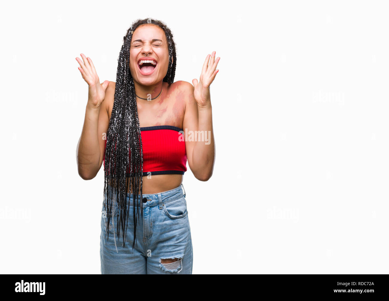 Young braided hair african american with pigmentation blemish birth ...