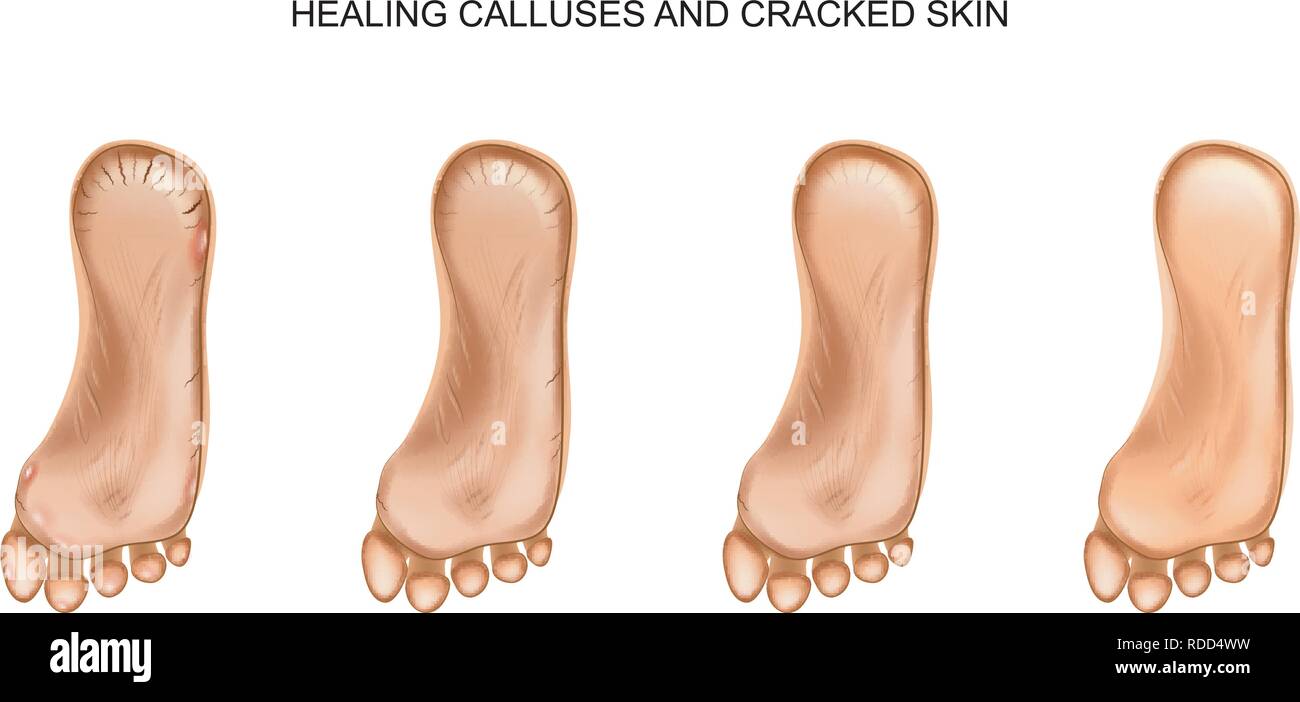 vector illustration of the healing calluses and cracked heels Stock ...