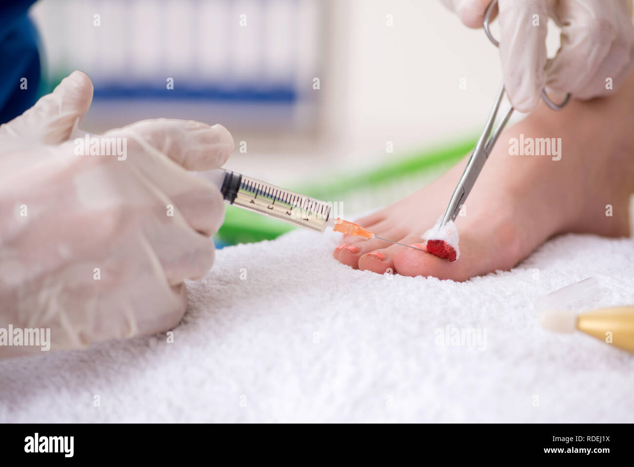 Podiatrist treating feet during procedure Stock Photo - Alamy