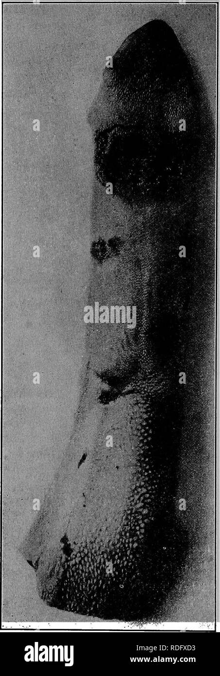 Necrosis foot hi-res stock photography and images - Alamy