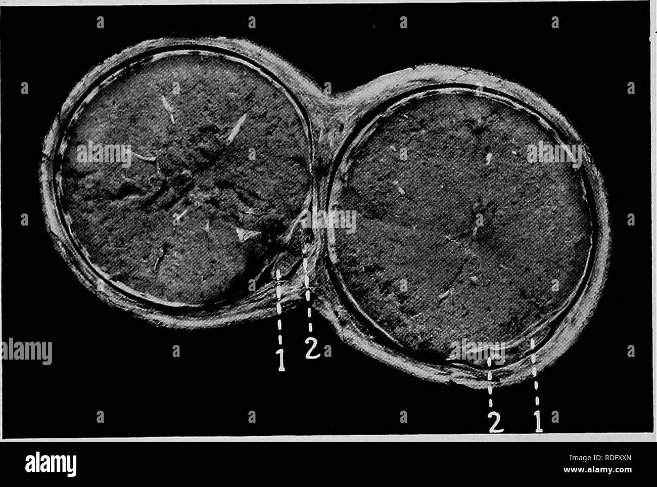 Gubernaculum Testis Tail