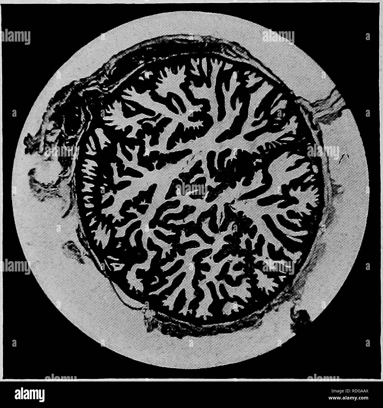 Hydrosalpinx High Resolution Stock Photography and Images - Alamy