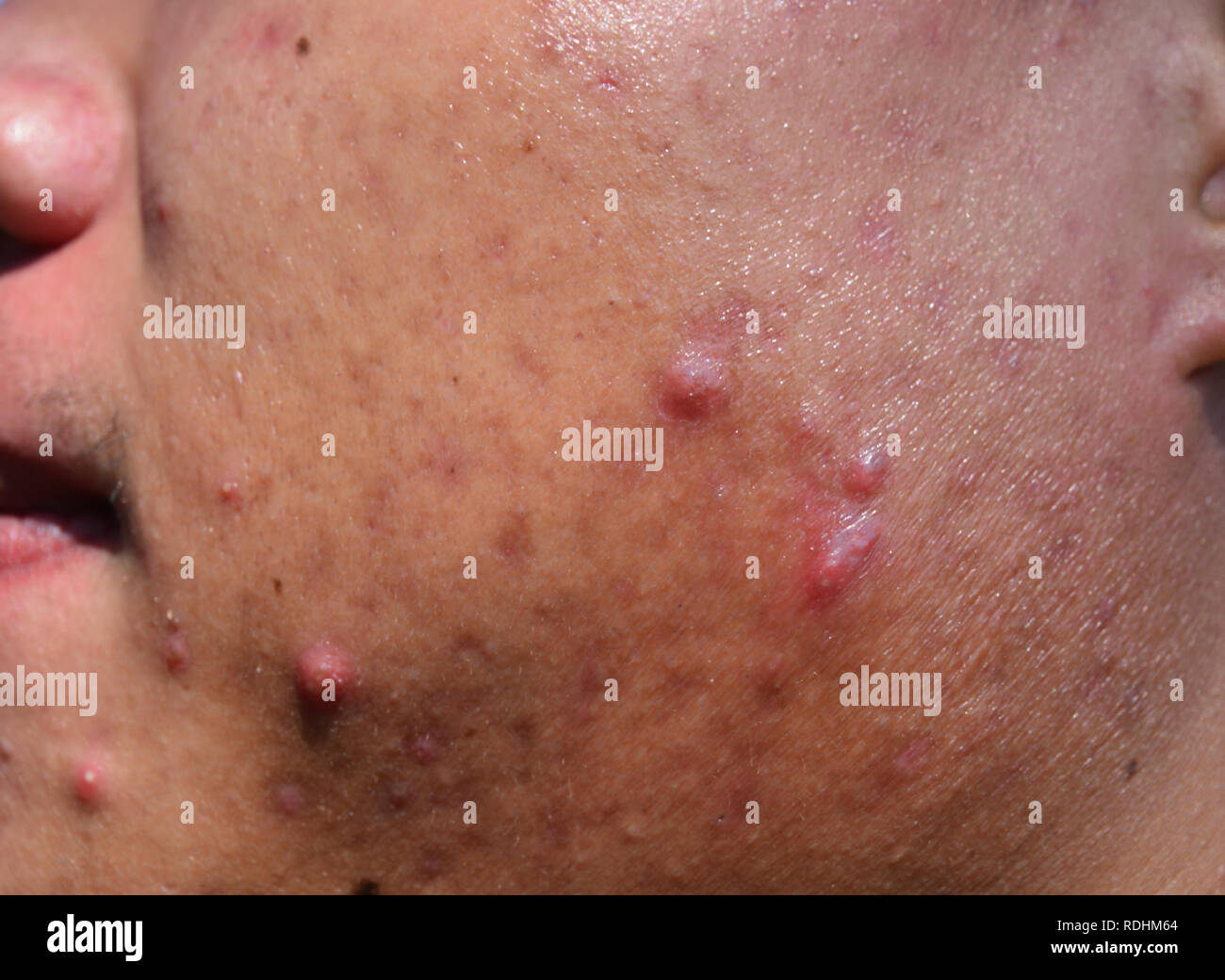 Cystic acne hi-res stock photography and images - Alamy