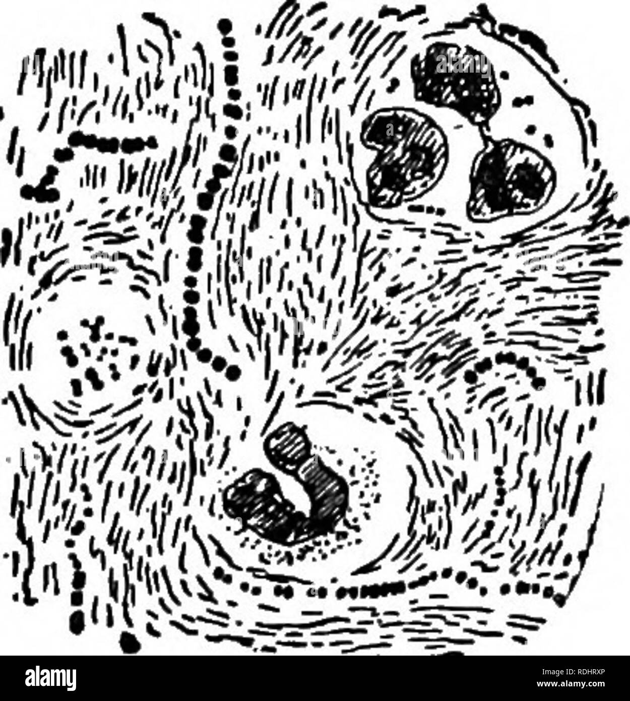 Subcutaneous phlegmon Black and White Stock Photos & Images - Alamy