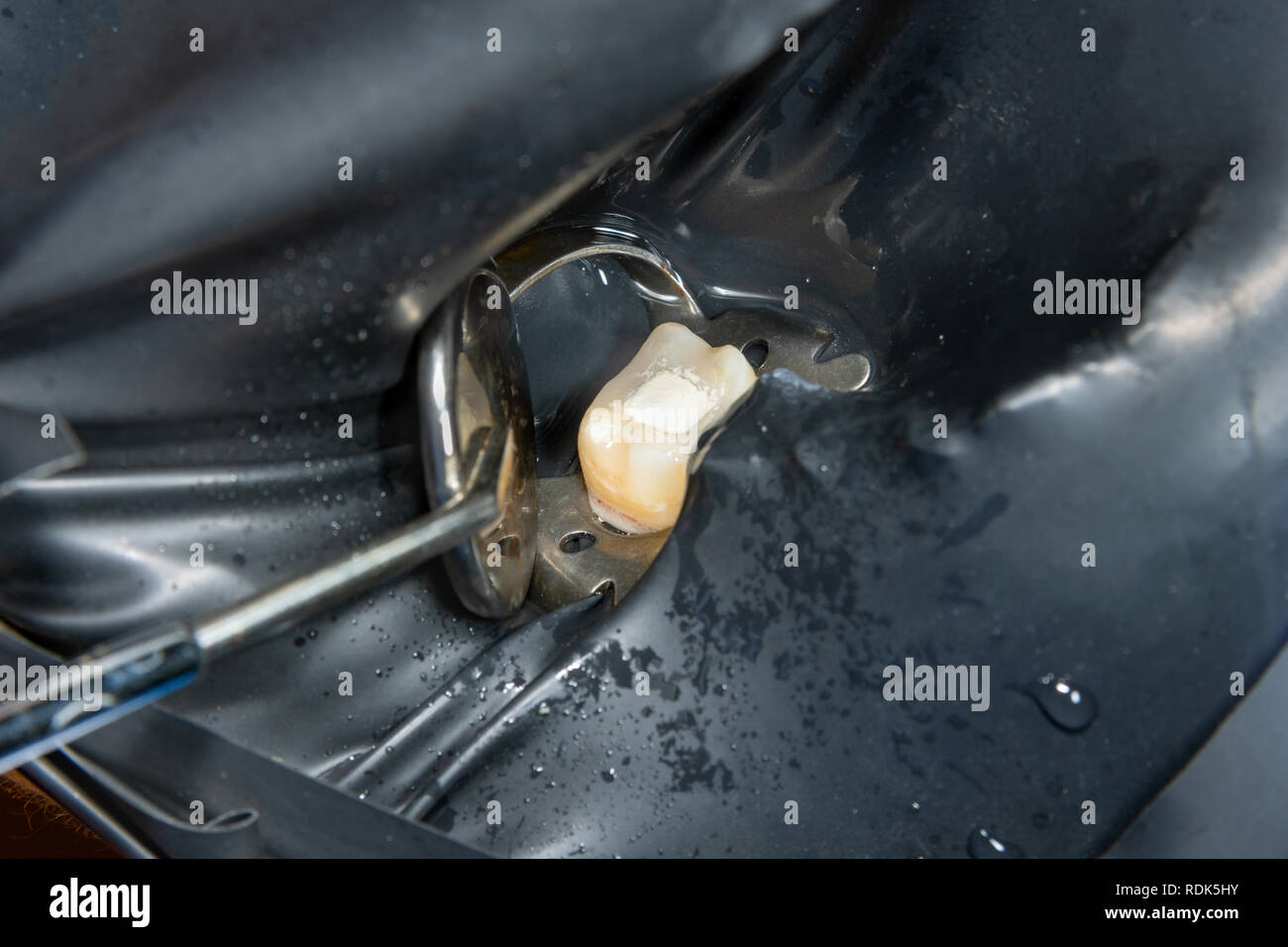 two chewing side teeth of the upper jaw after treatment of caries ...