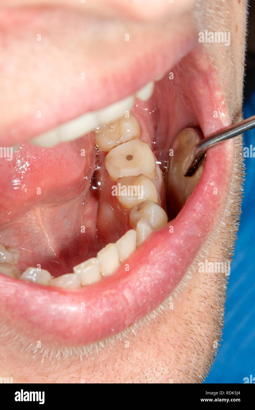 two chewing side teeth of the upper jaw after treatment of caries ...