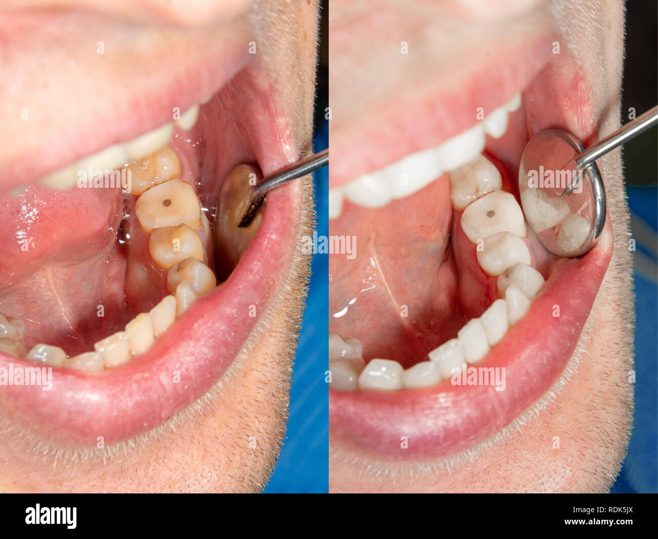 two chewing side teeth of the upper jaw after treatment of caries ...