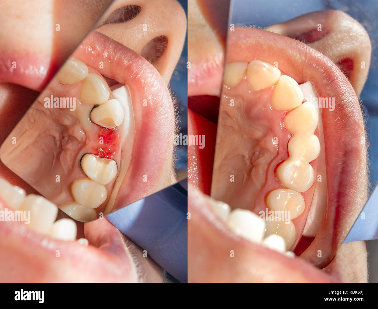 Sealing tooth hi-res stock photography and images - Alamy