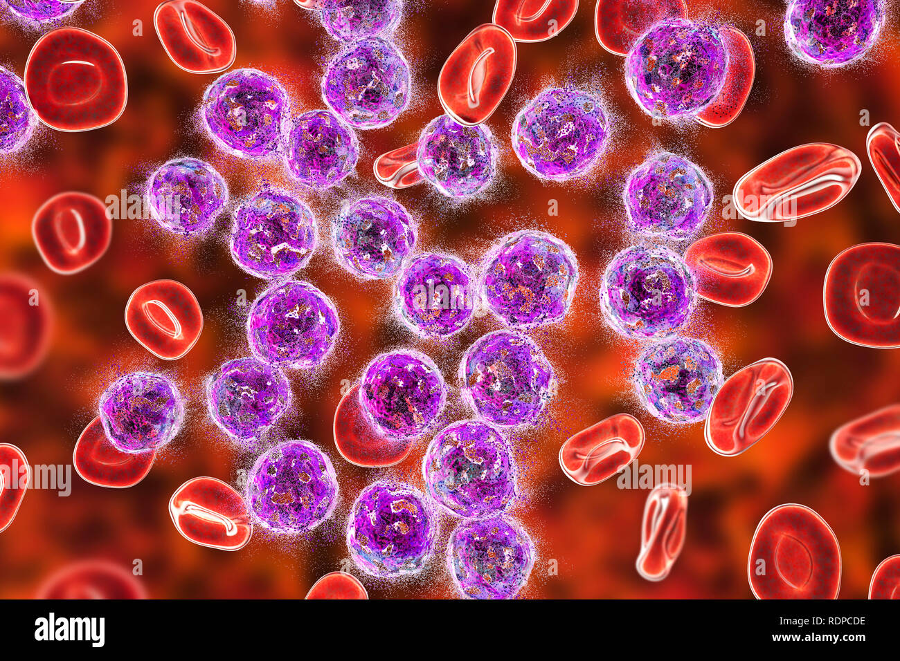 Acute leukemia hi-res stock photography and images - Alamy