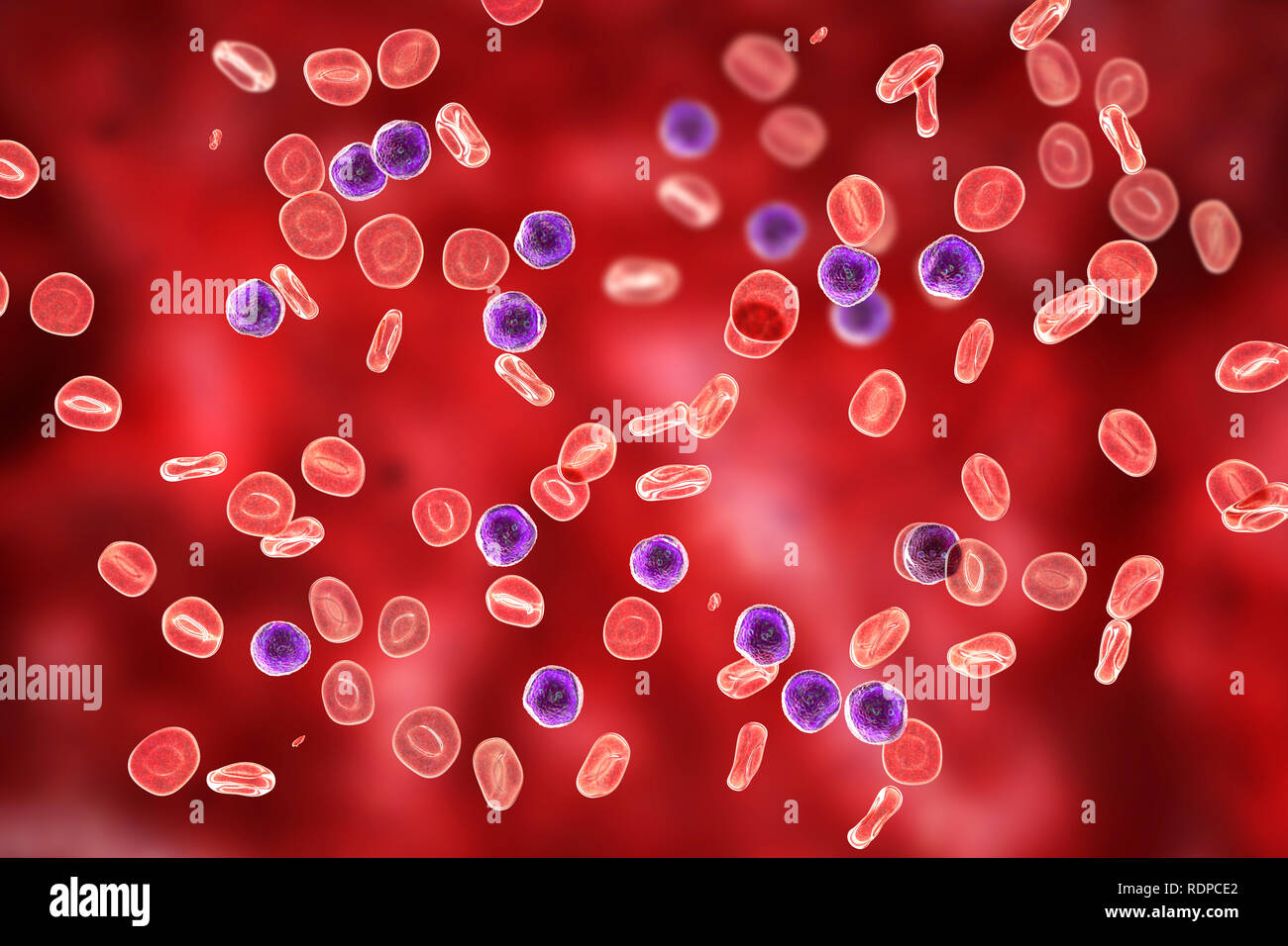 Acute lymphoblastic leukaemia. Computer illustration showing abundant ...