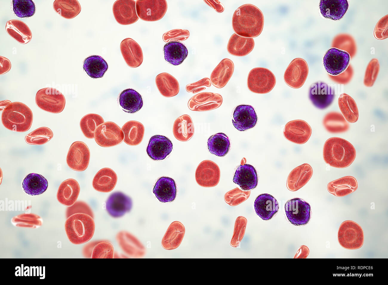 Acute lymphoblastic leukaemia. Computer illustration showing abundant ...
