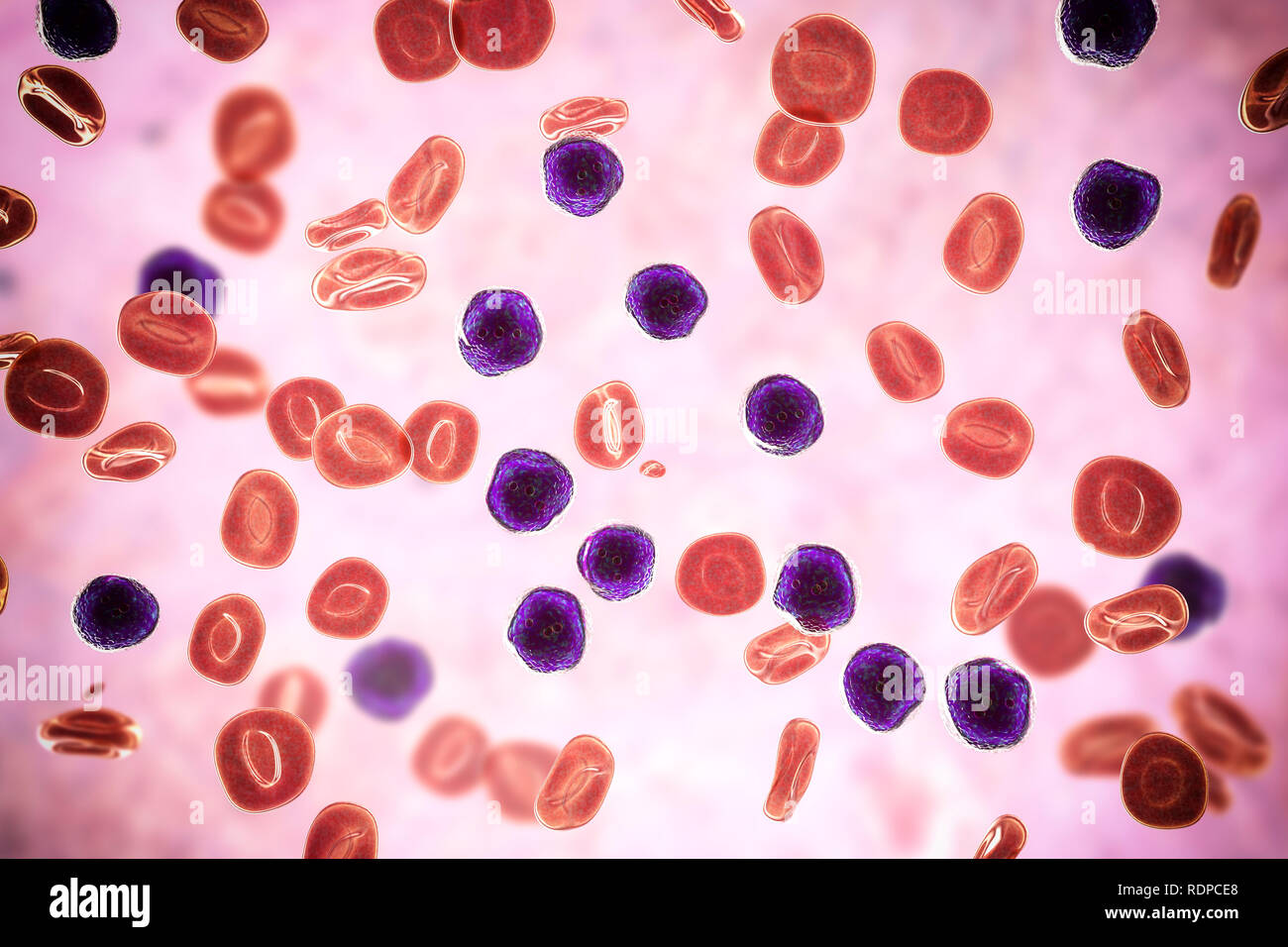 Acute lymphoblastic leukaemia. Computer illustration showing abundant ...