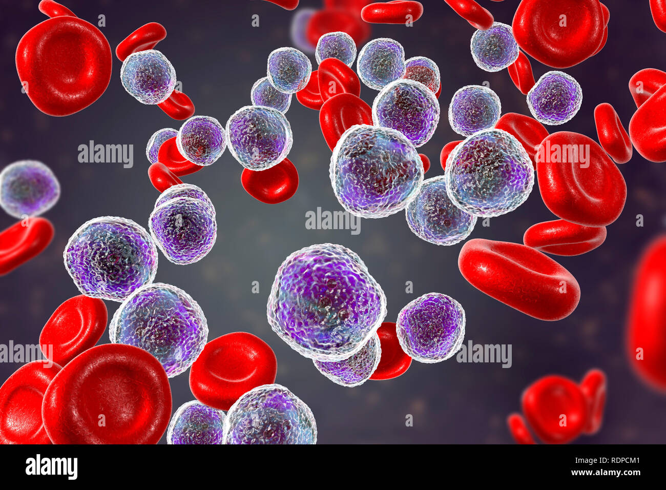 Acute lymphoblastic leukaemia bone marrow smear. Computer illustration ...