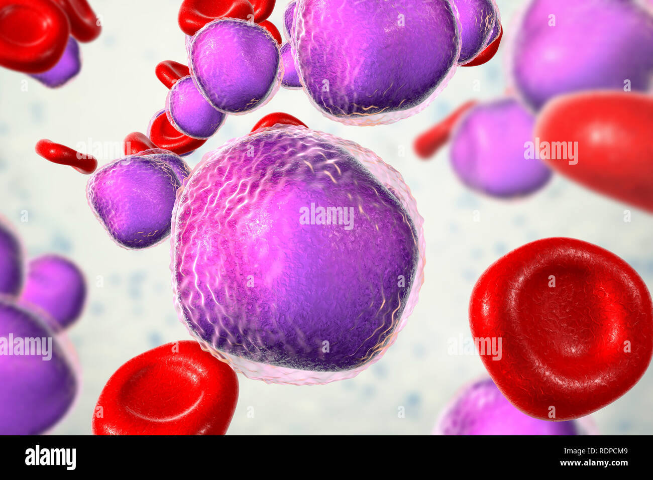 Acute lymphoblastic leukaemia bone marrow smear. Computer illustration ...