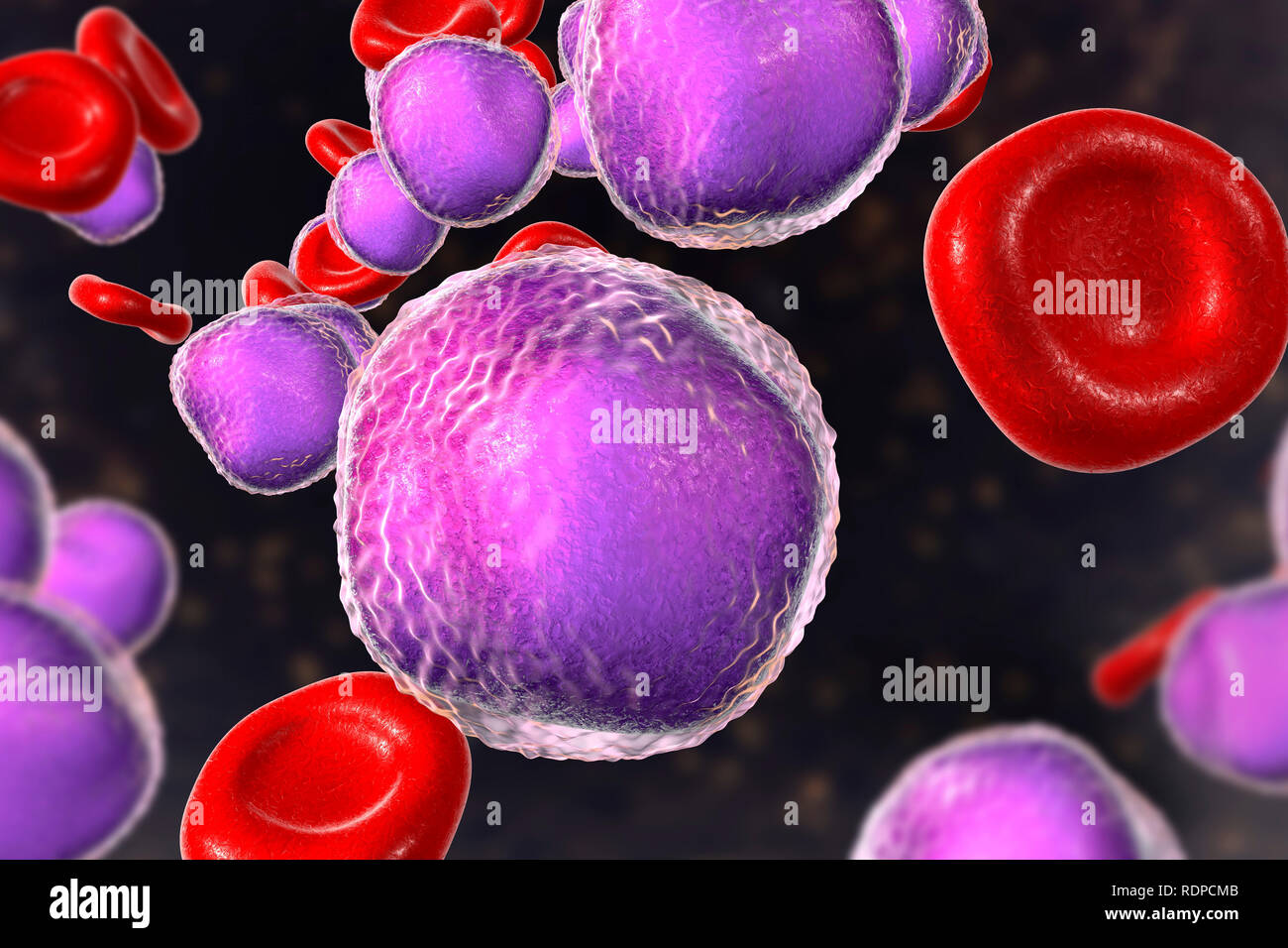 Acute lymphoblastic leukaemia bone marrow smear. Computer illustration ...