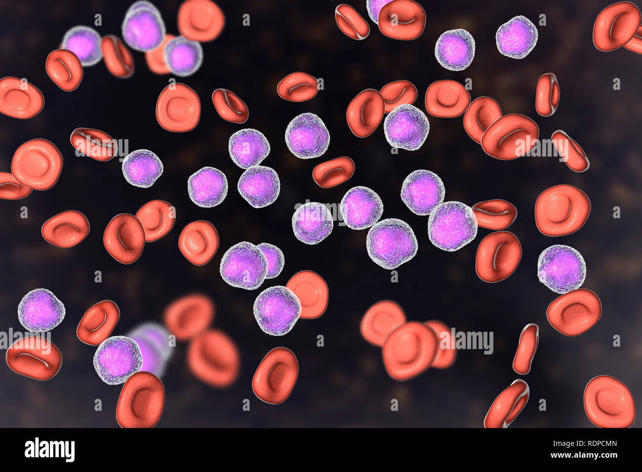 Acute lymphoblastic leukaemia bone marrow smear. Computer illustration ...