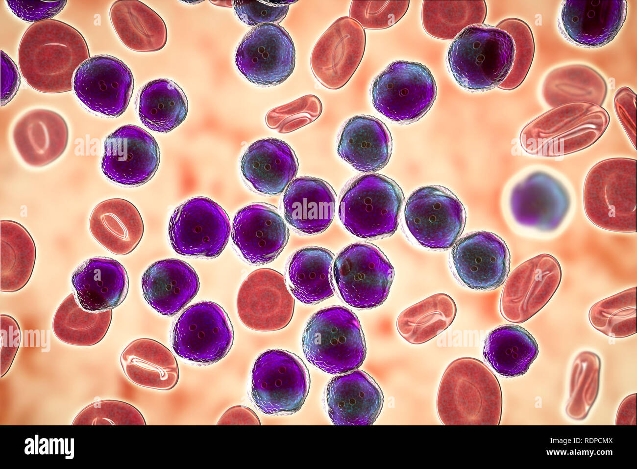 Acute lymphoblastic leukaemia bone marrow smear. Computer illustration ...