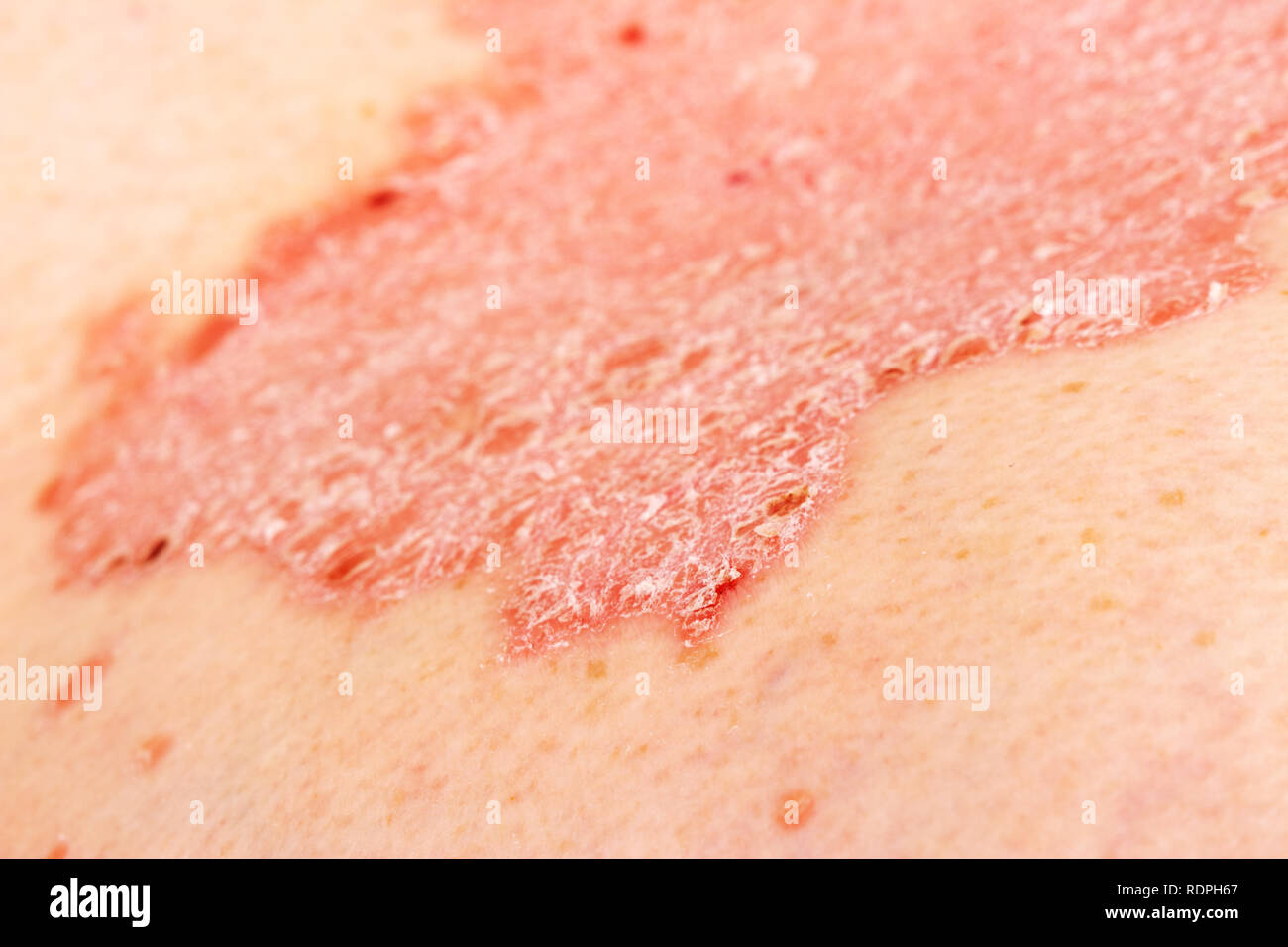 Psoriatic Skin High Resolution Stock Photography and Images - Alamy