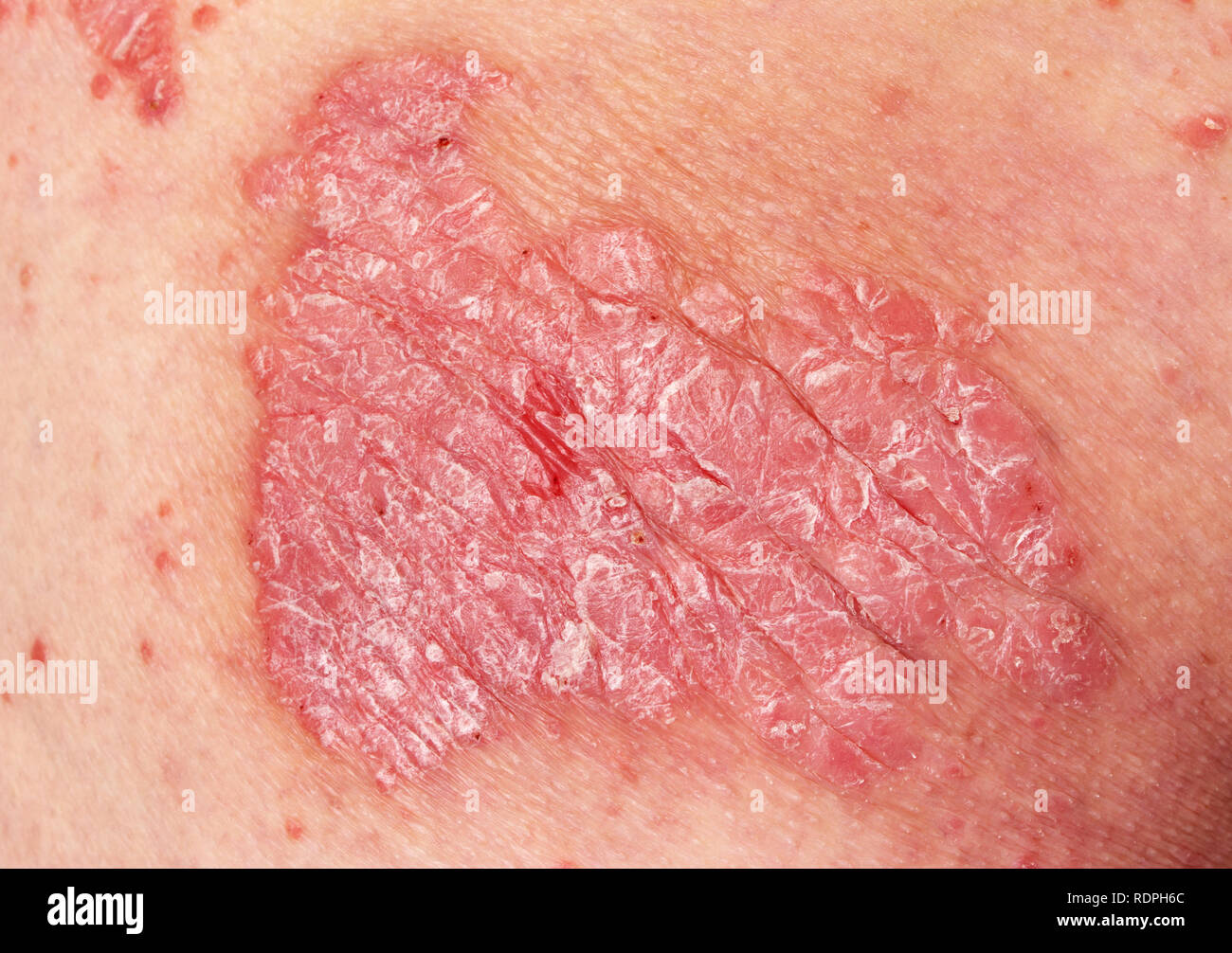 Itchy Patches High Resolution Stock Photography and Images - Alamy