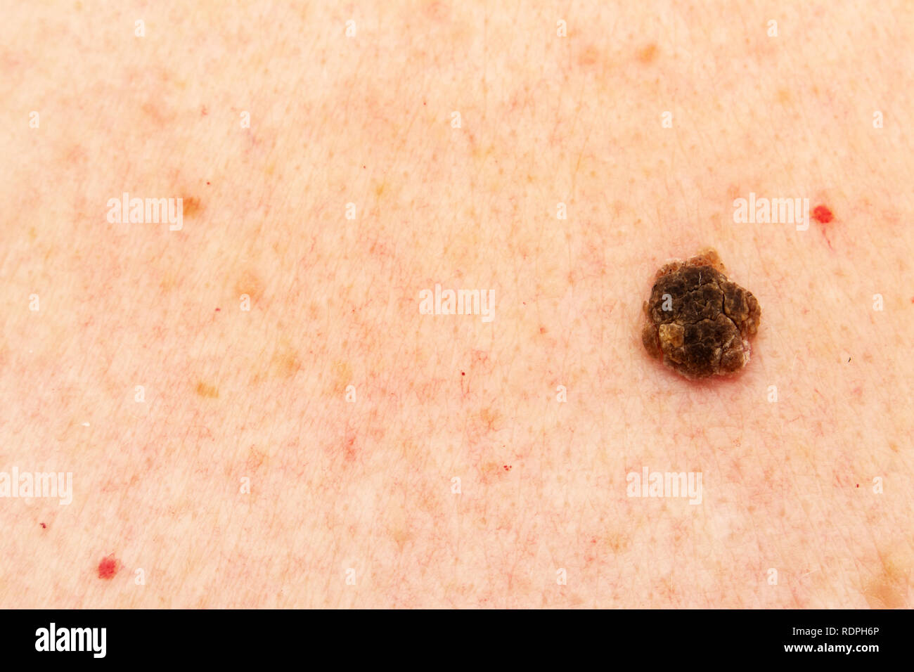 Seborrheic Keratosis High Resolution Stock Photography and Images - Alamy