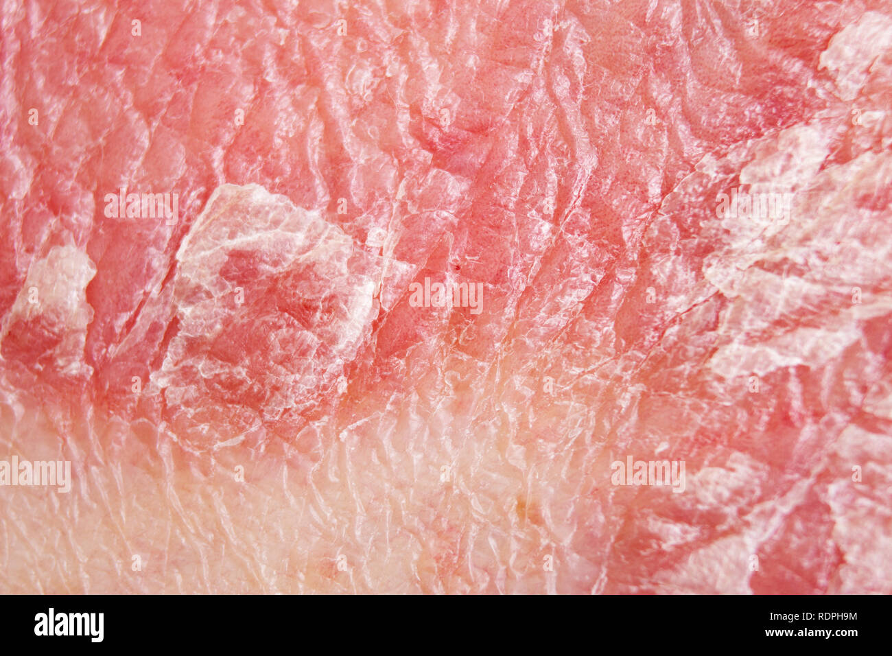 Psoriasis Vulgaris High Resolution Stock Photography and Images - Alamy