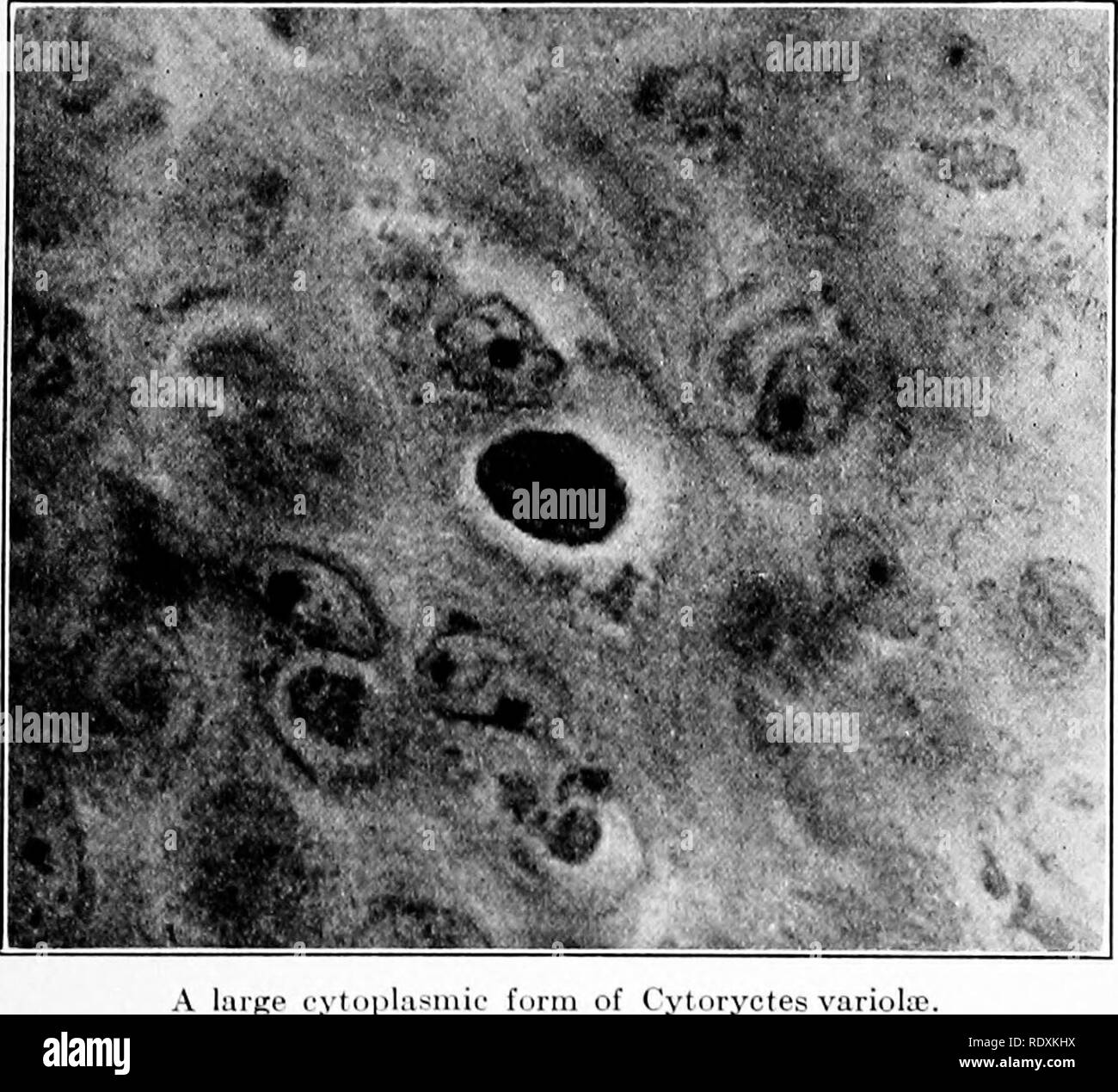 Pustules Black and White Stock Photos & Images - Alamy