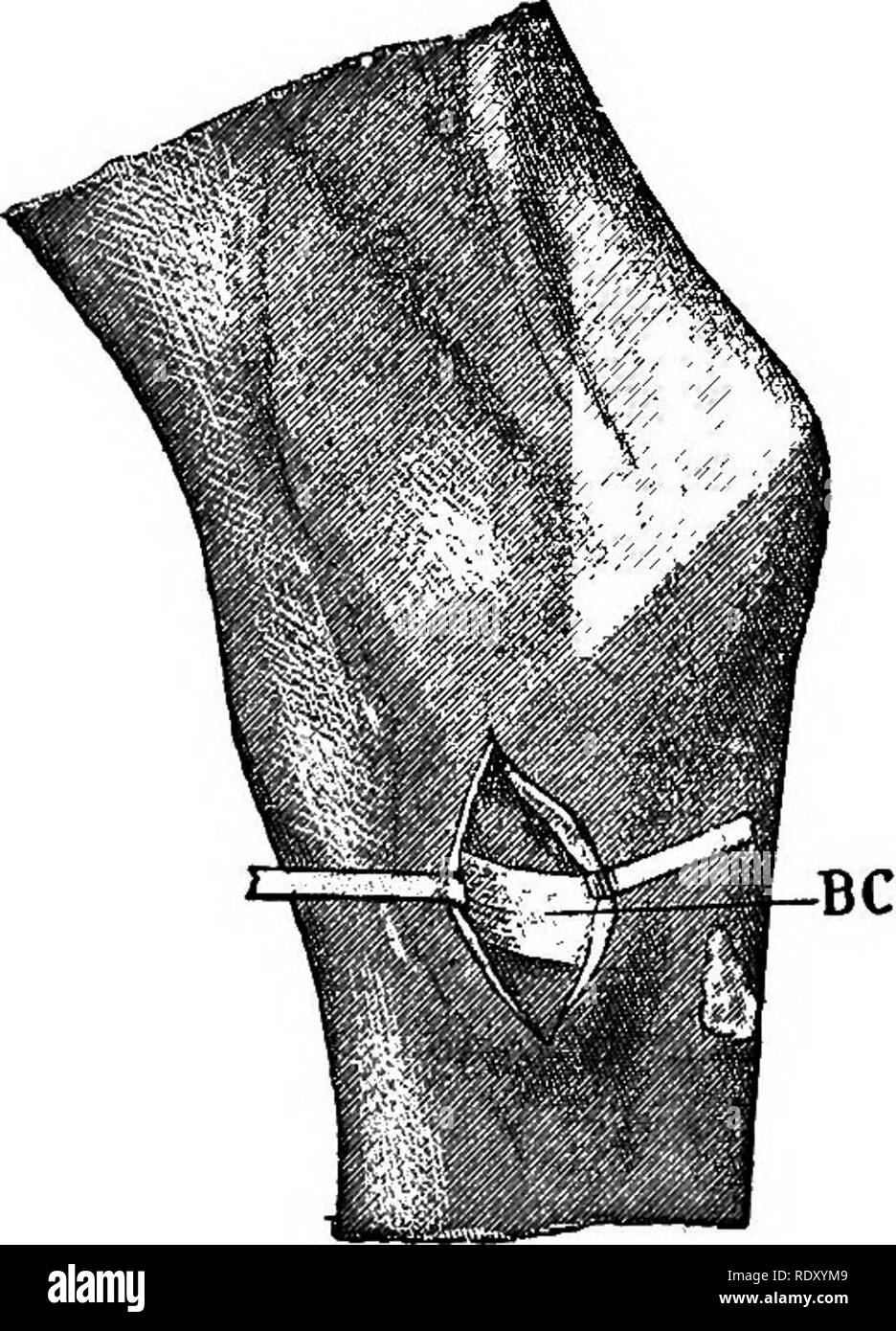 Surgical stitches Black and White Stock Photos & Images - Alamy