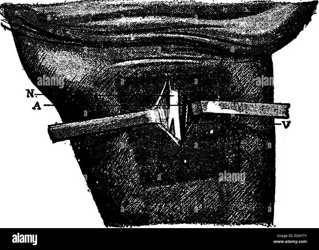 Elbow incision Black and White Stock Photos & Images - Alamy