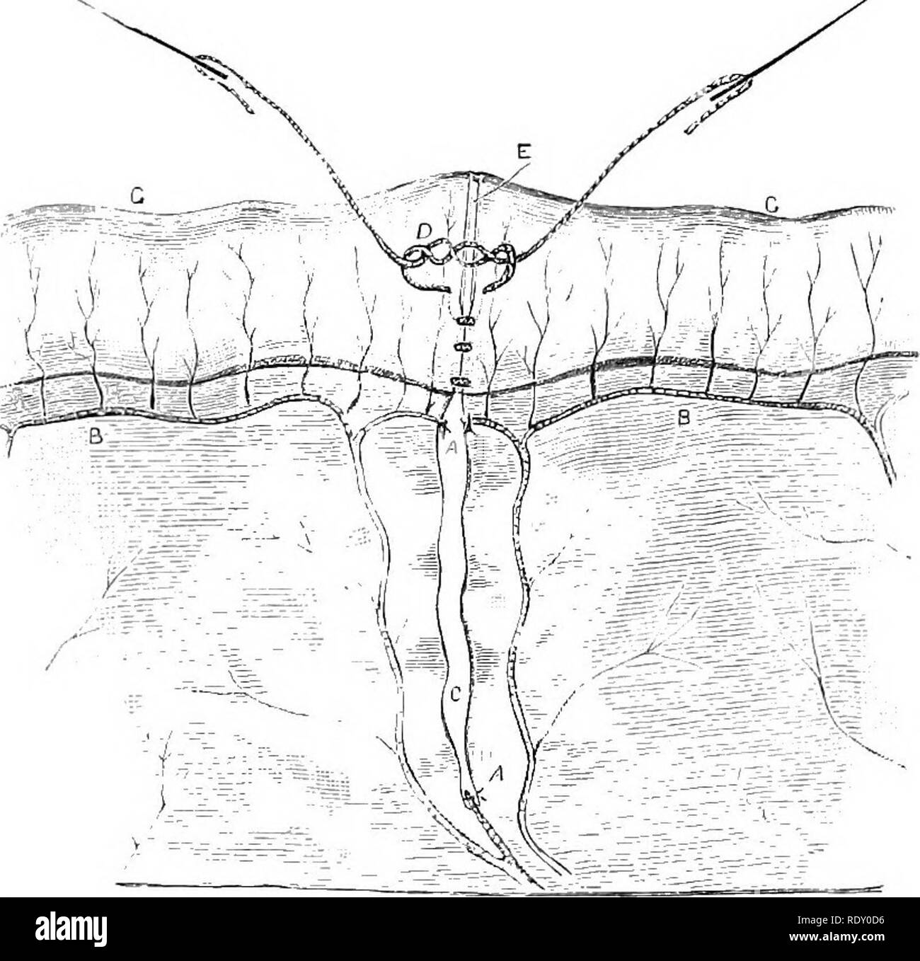 Laparotomy Black and White Stock Photos & Images - Alamy