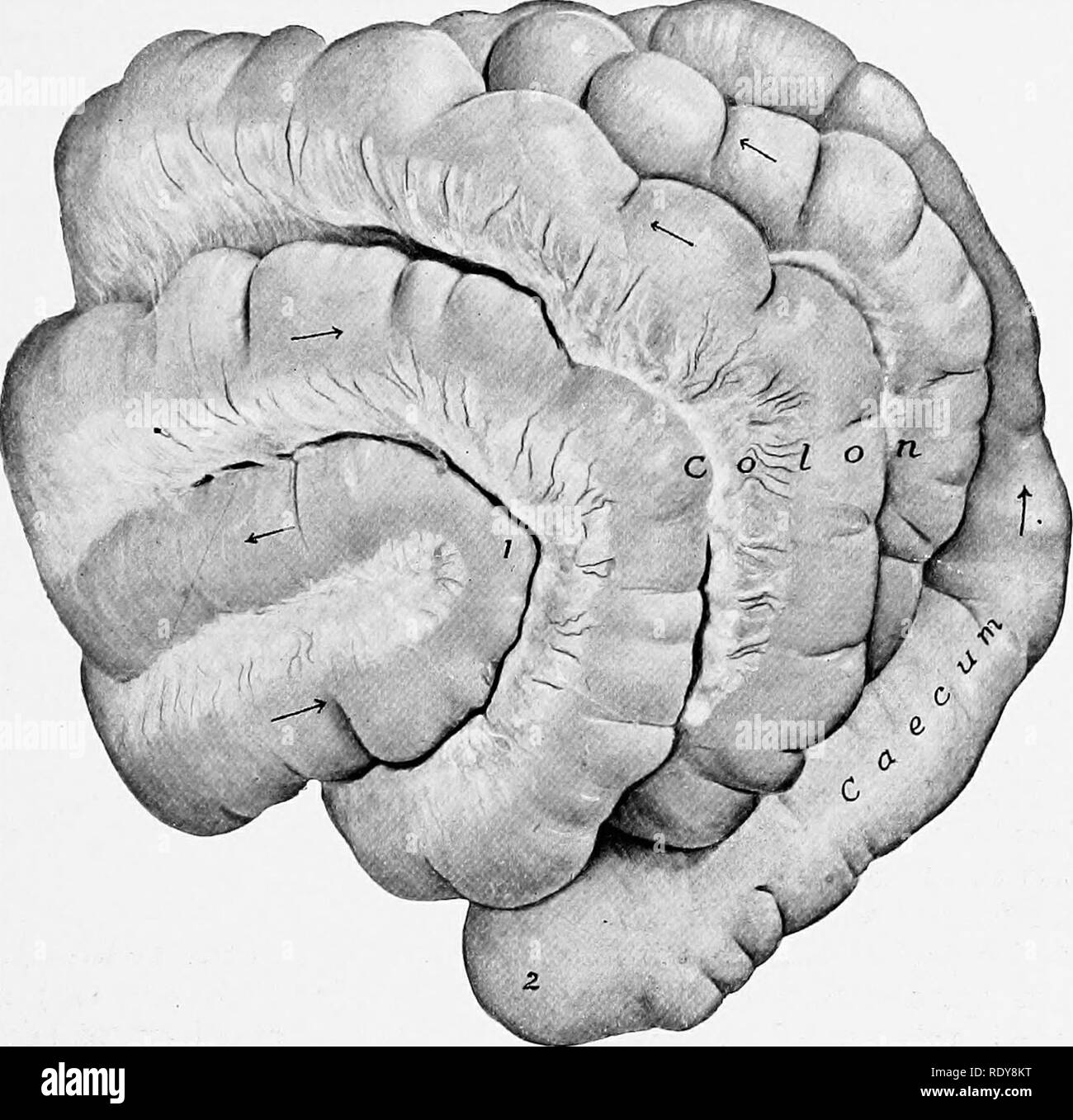 Large intestine mesentery hi-res stock photography and images - Alamy