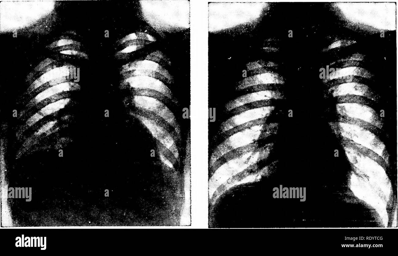 Pleural lung collapse hi-res stock photography and images - Alamy