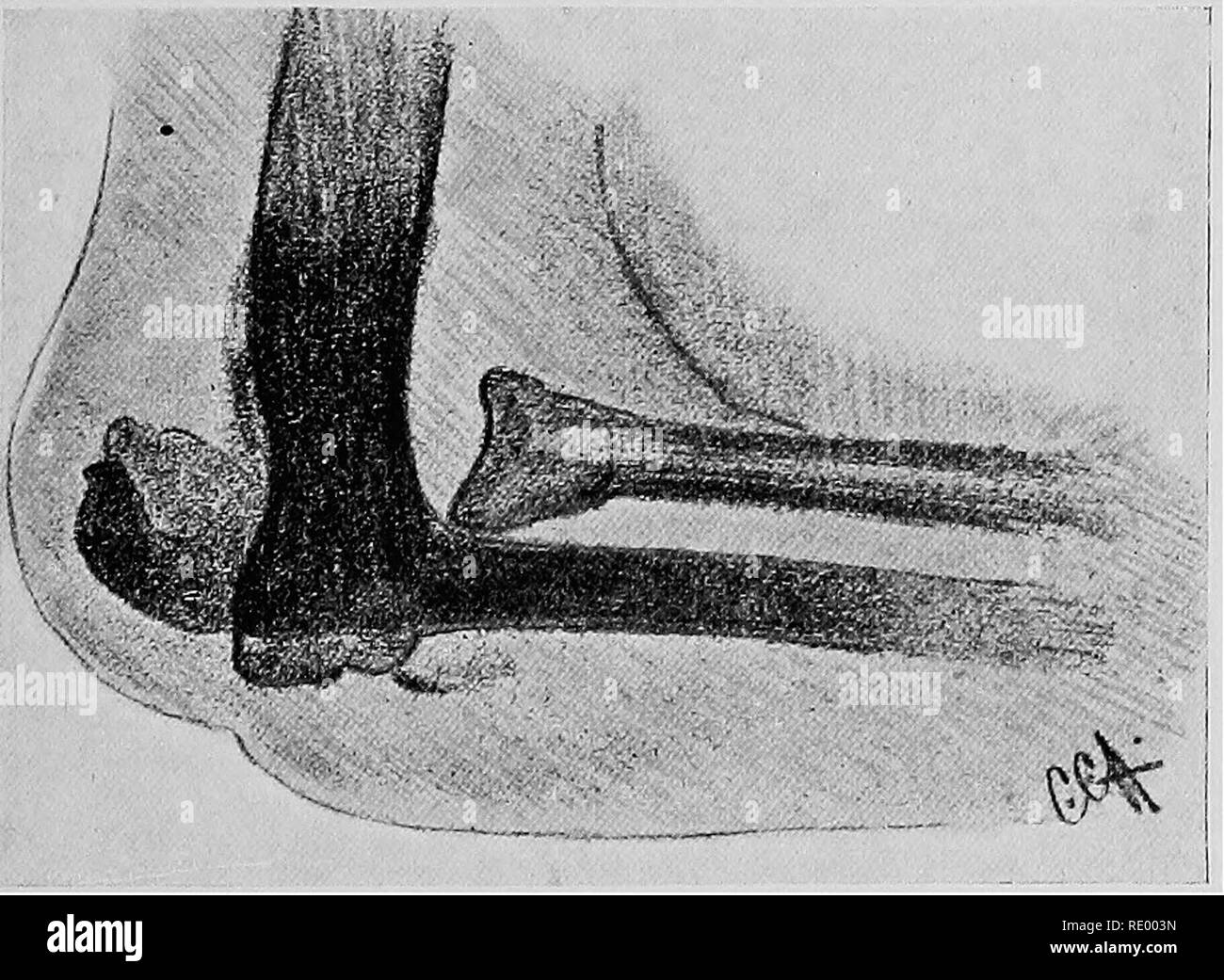 Dislocation Elbow Stock Photos & Dislocation Elbow Stock Images - Alamy