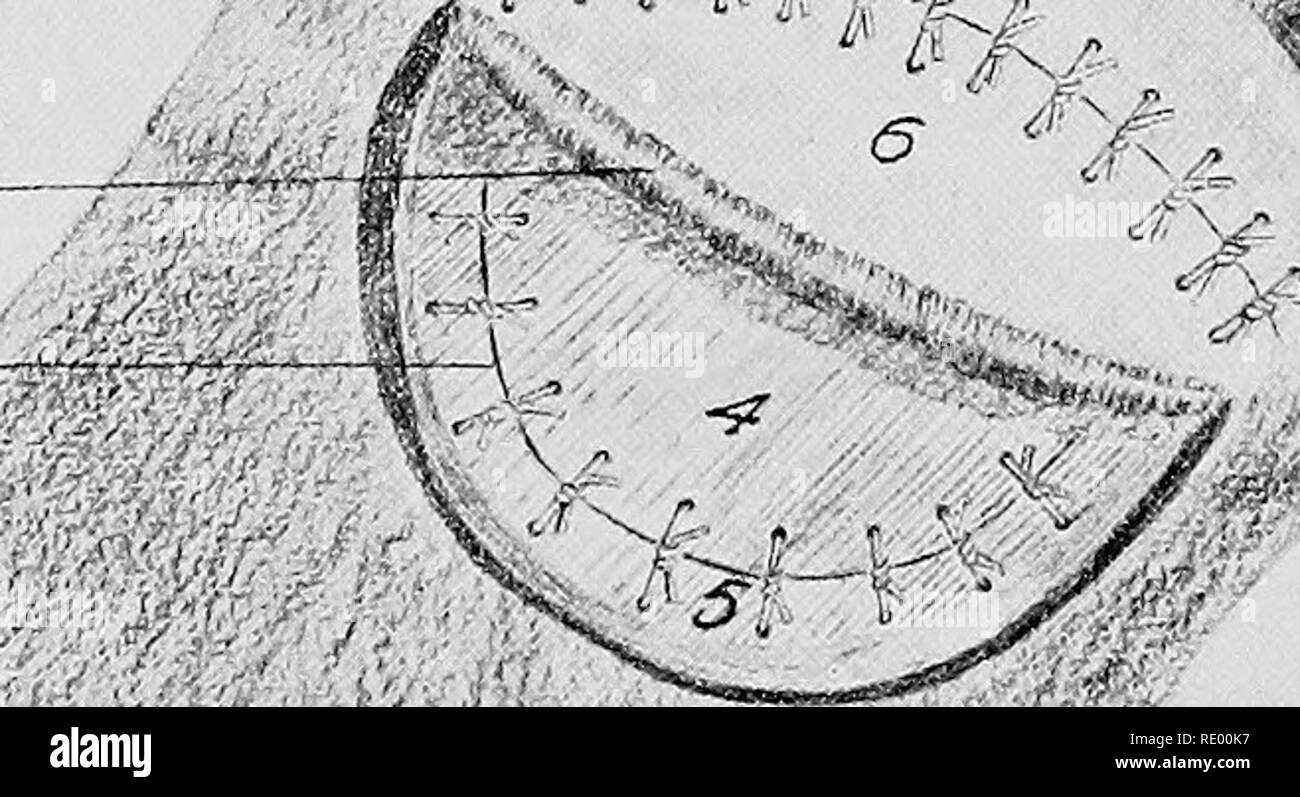 Anterior flap Black and White Stock Photos & Images - Alamy