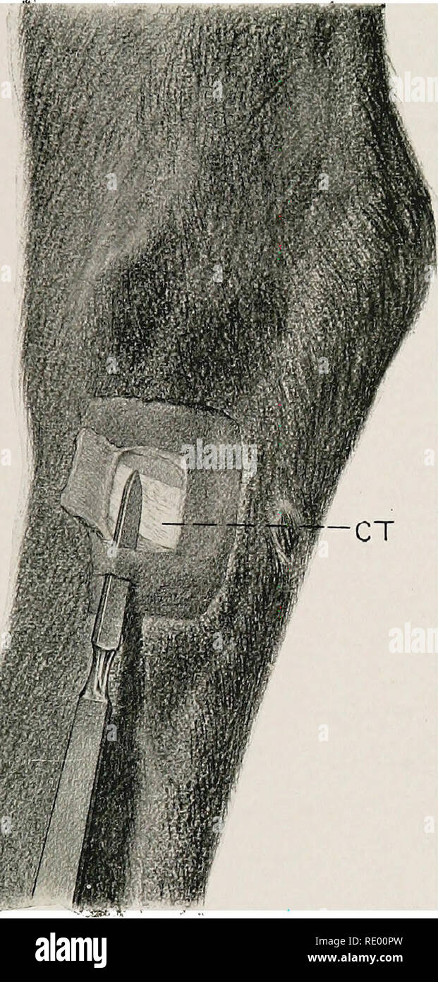 Tenotomy High Resolution Stock Photography and Images - Alamy