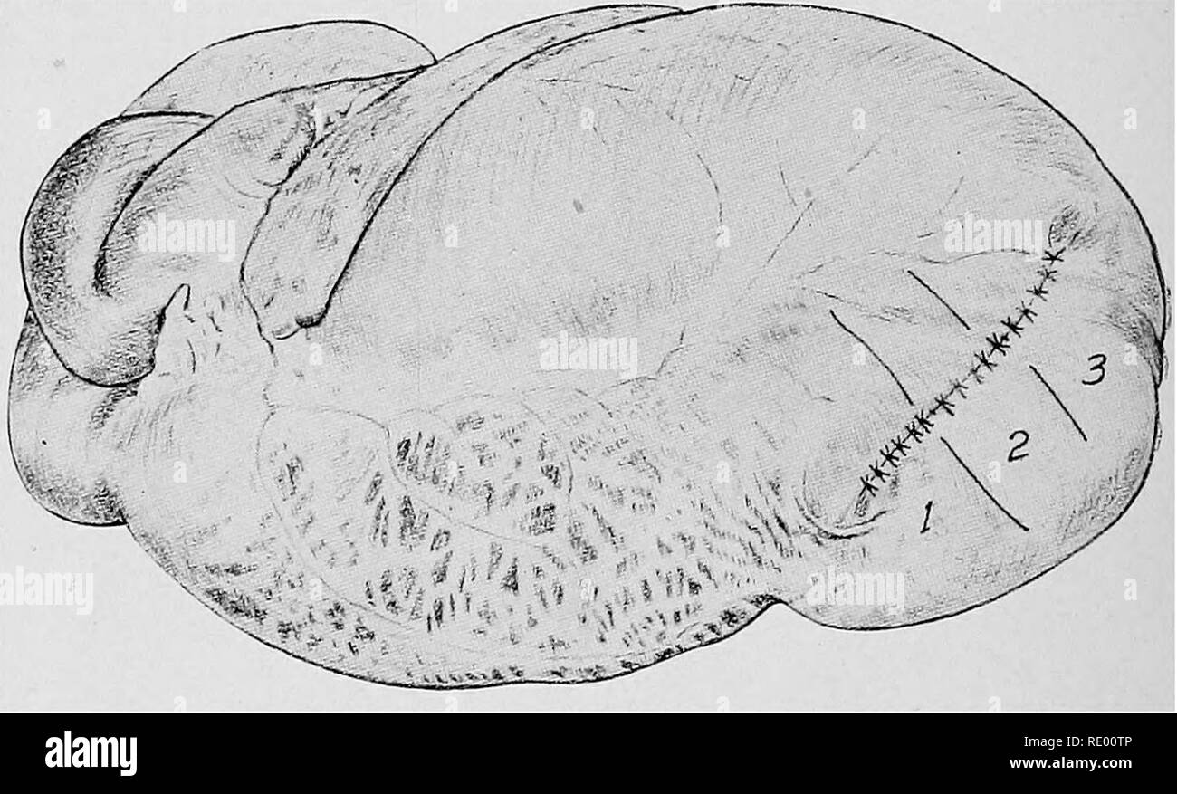 General anaesthesia Black and White Stock Photos & Images - Alamy