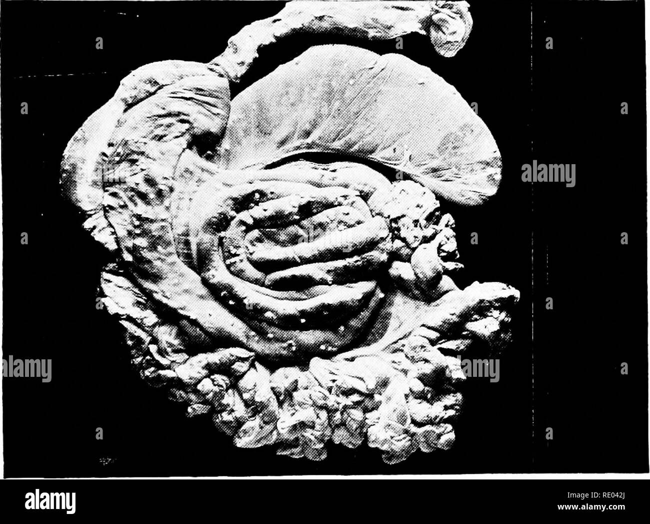 Large intestine diseased tissue hi-res stock photography and images - Alamy