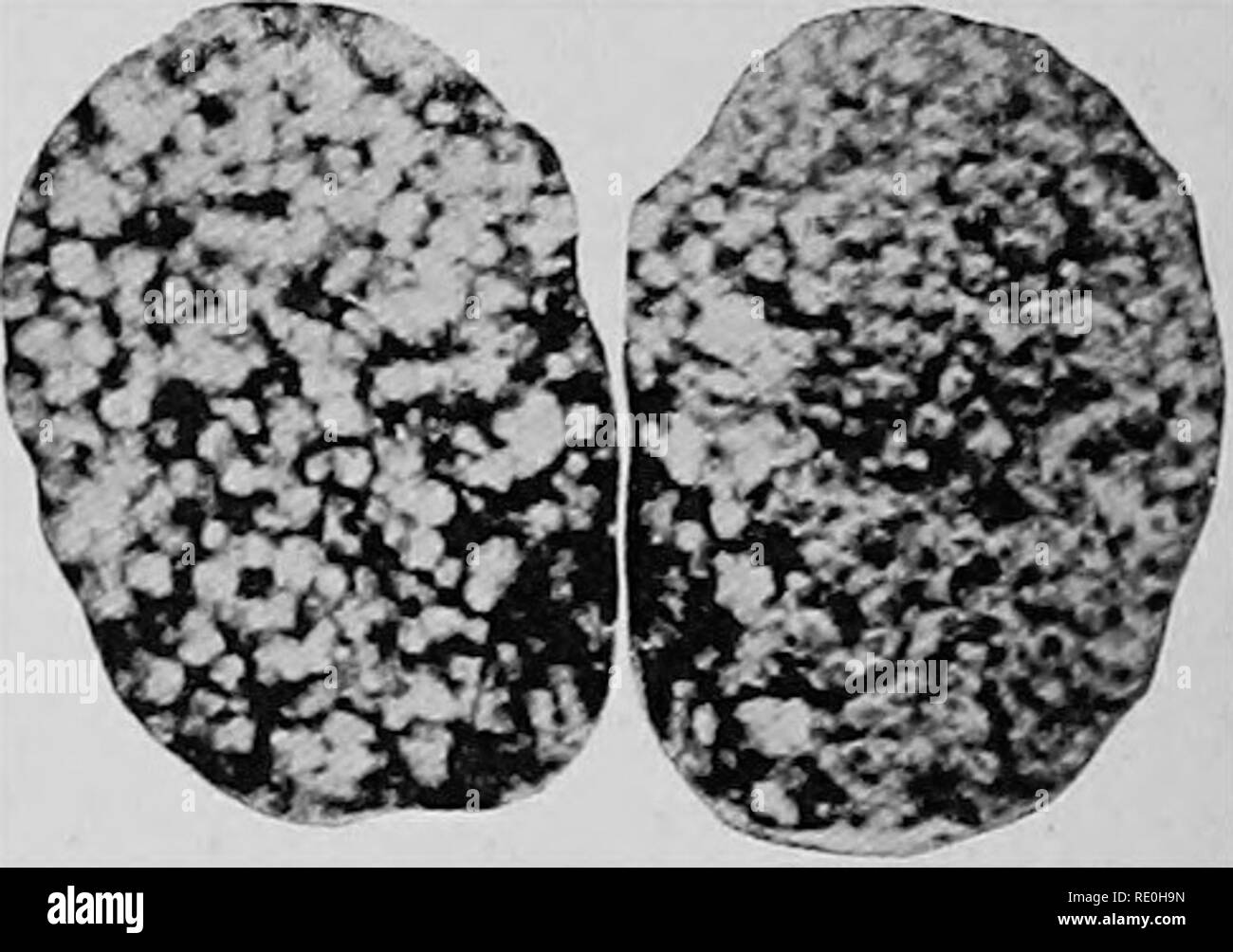 Liver disease skin Black and White Stock Photos & Images - Alamy