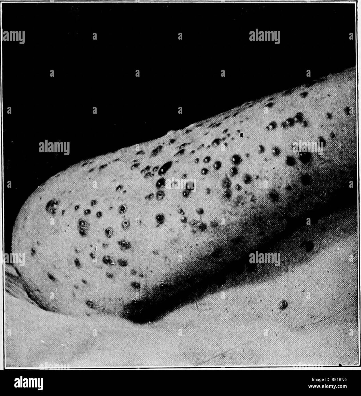 Pustular eruption hi-res stock photography and images - Alamy