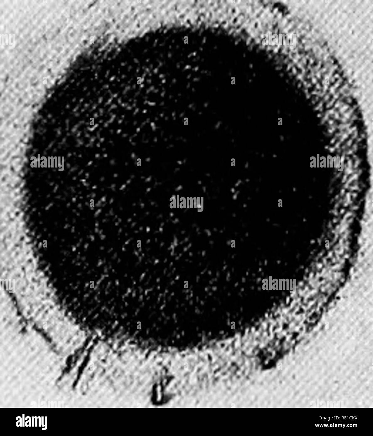 Cellulitis Black and White Stock Photos & Images - Alamy