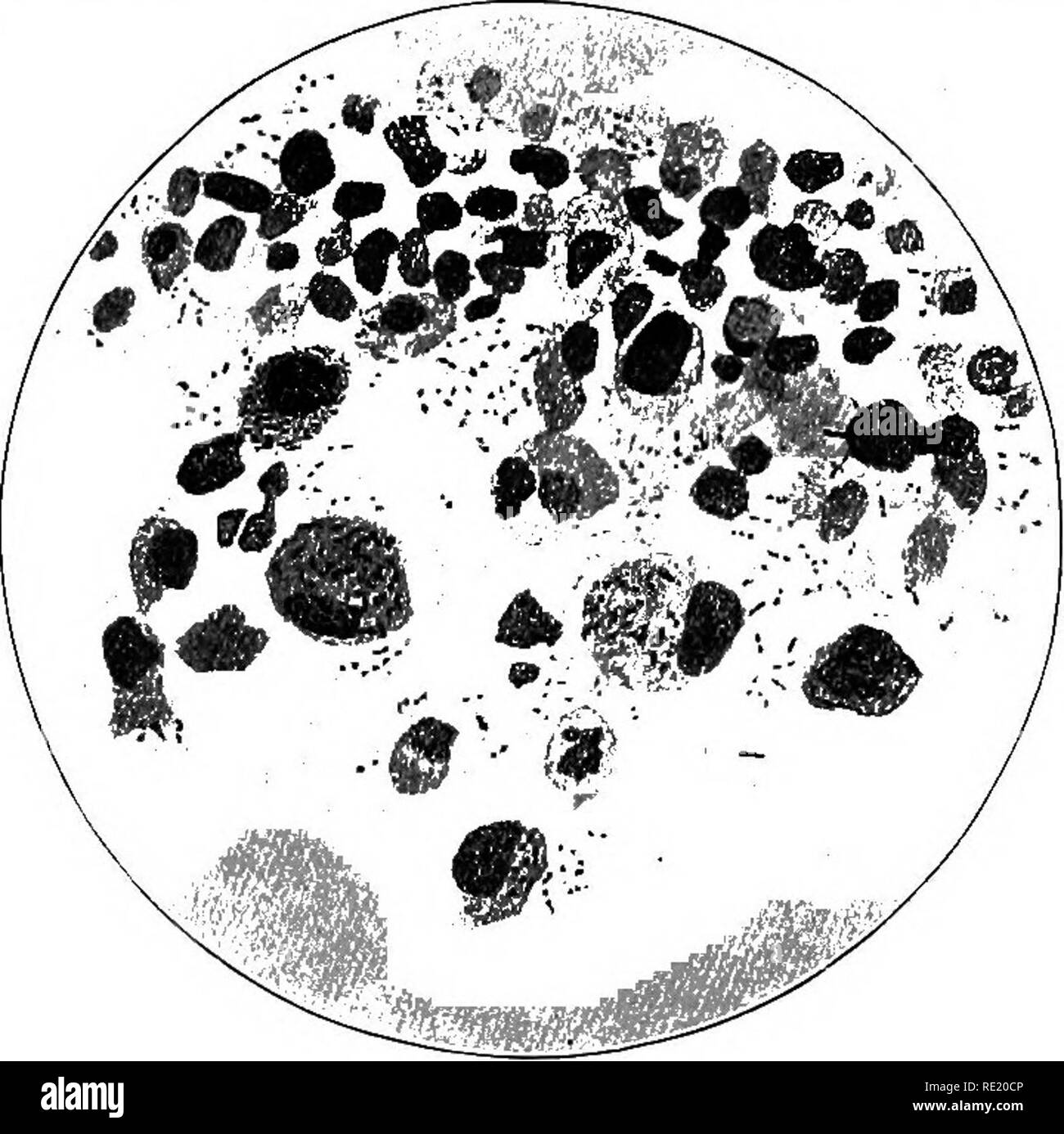 Buboes hi-res stock photography and images - Alamy