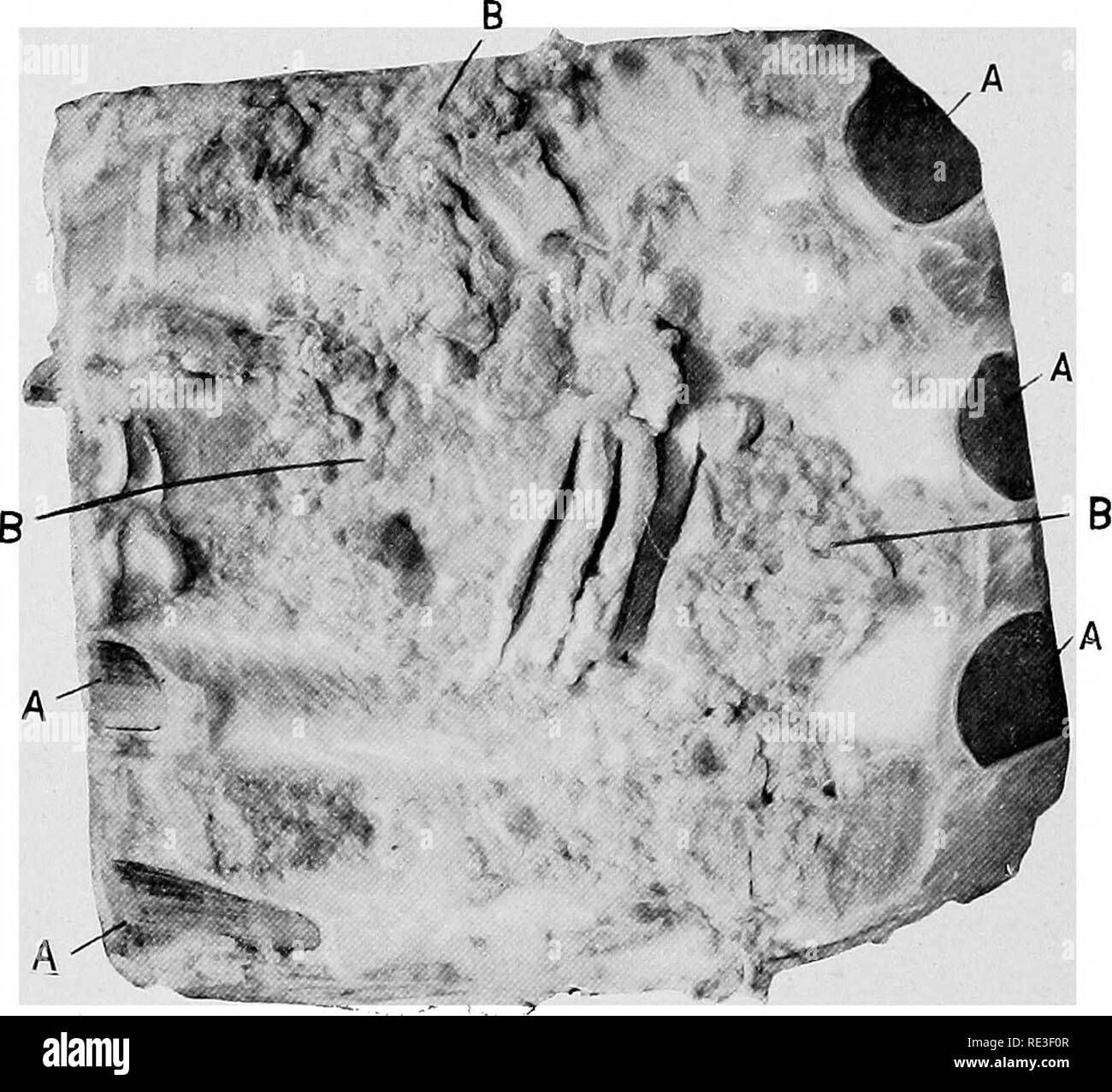 Osseous tuberculosis hi-res stock photography and images - Alamy