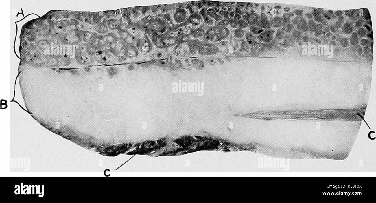 Tuberculous nodule hi-res stock photography and images - Alamy