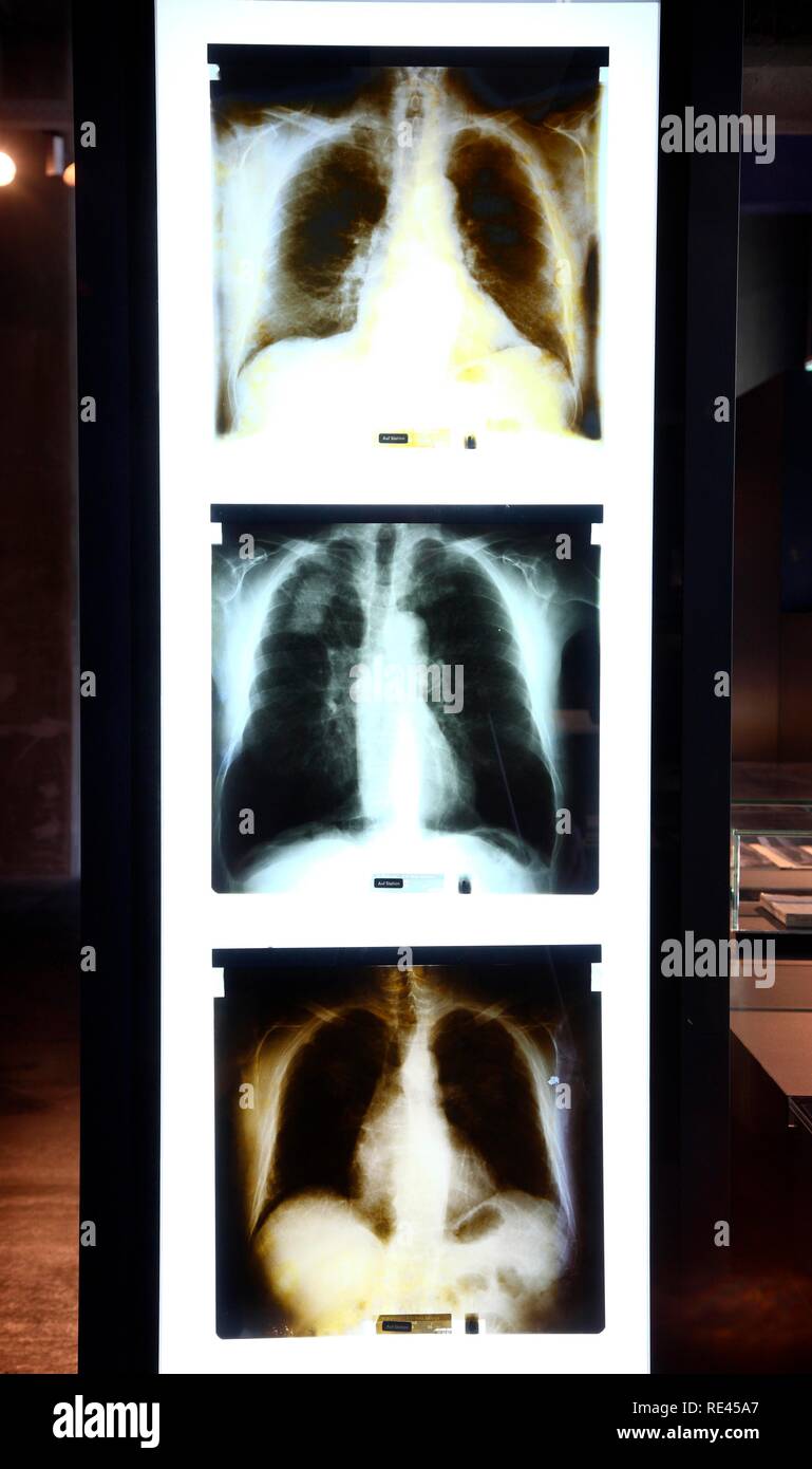 X-rays of miners' lungs, so-called black lung, Coalworker's ...