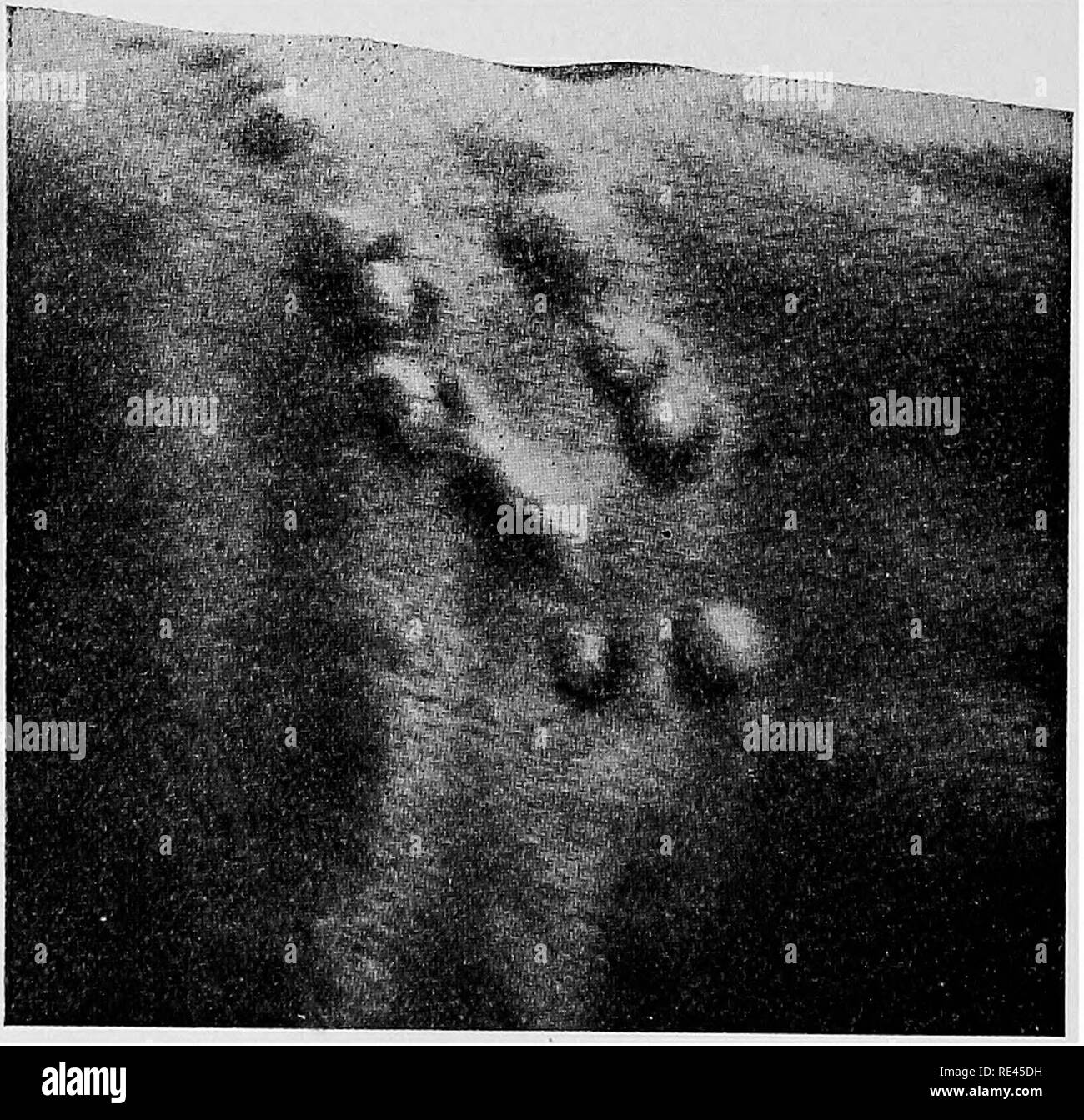 Eruption skin Black and White Stock Photos & Images - Alamy