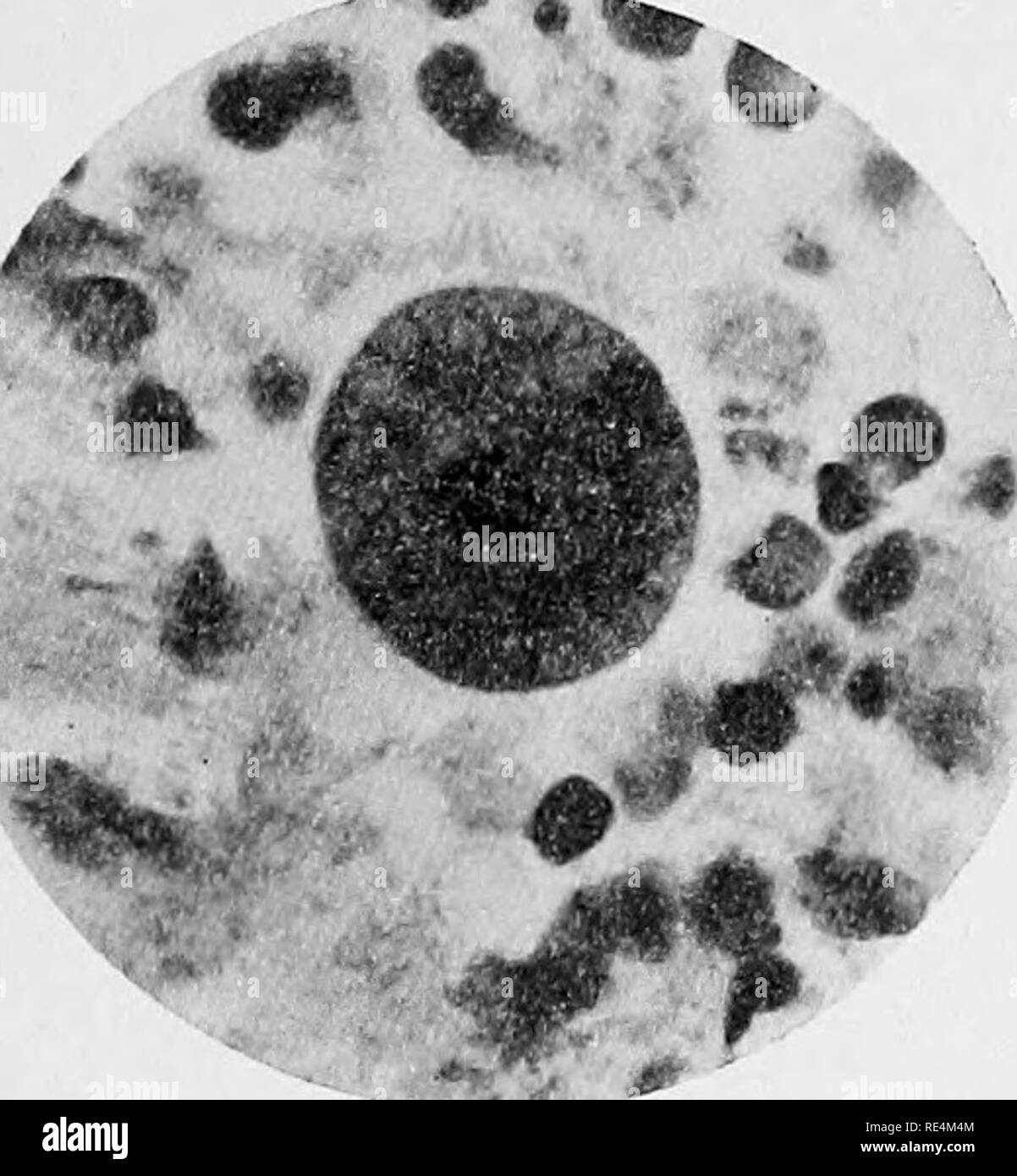 Appendix abscess Black and White Stock Photos & Images - Alamy