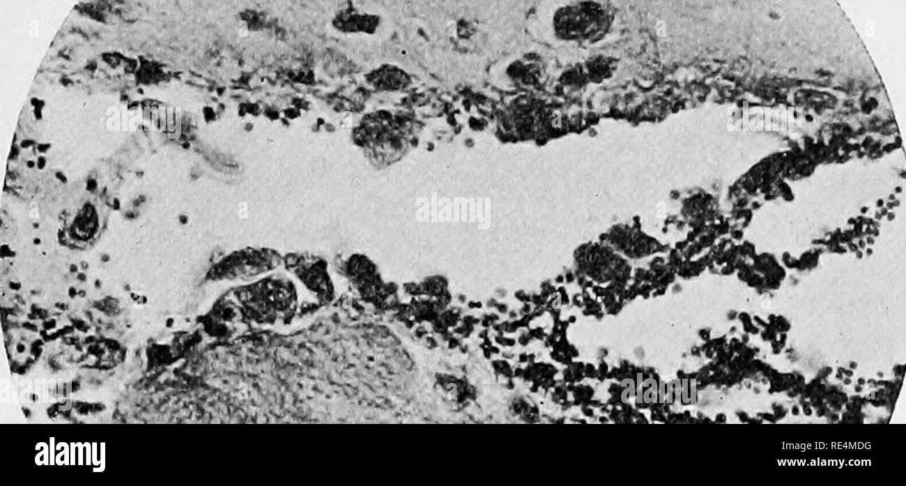 Pyaemia hi-res stock photography and images - Alamy